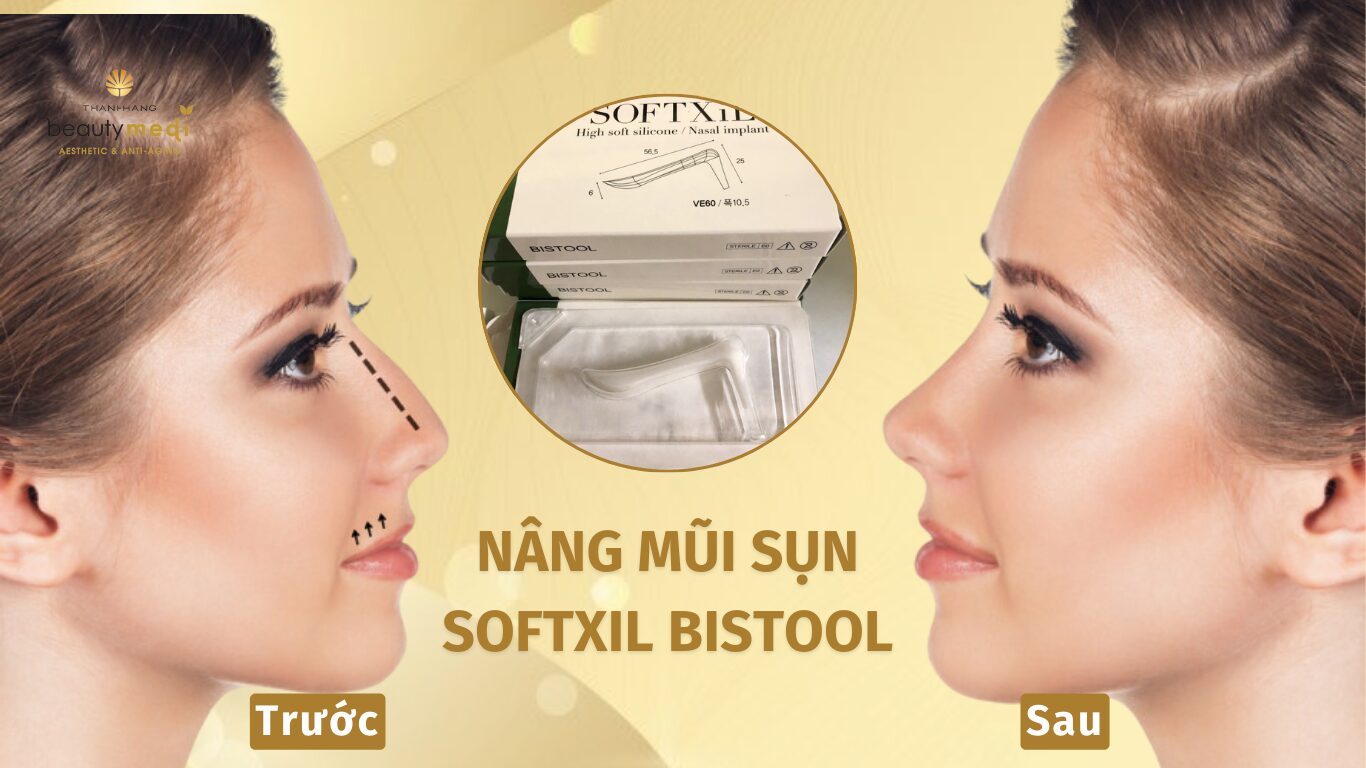 » Các loại sụn nâng mũi phổ biến, tốt nhất 2024 – Ưu nhược điểm từng loại